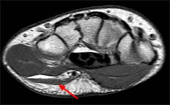 Extensor Digitorum Brevis Mri