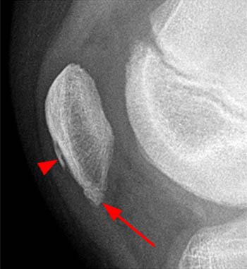 Developmental Variants - Radsource